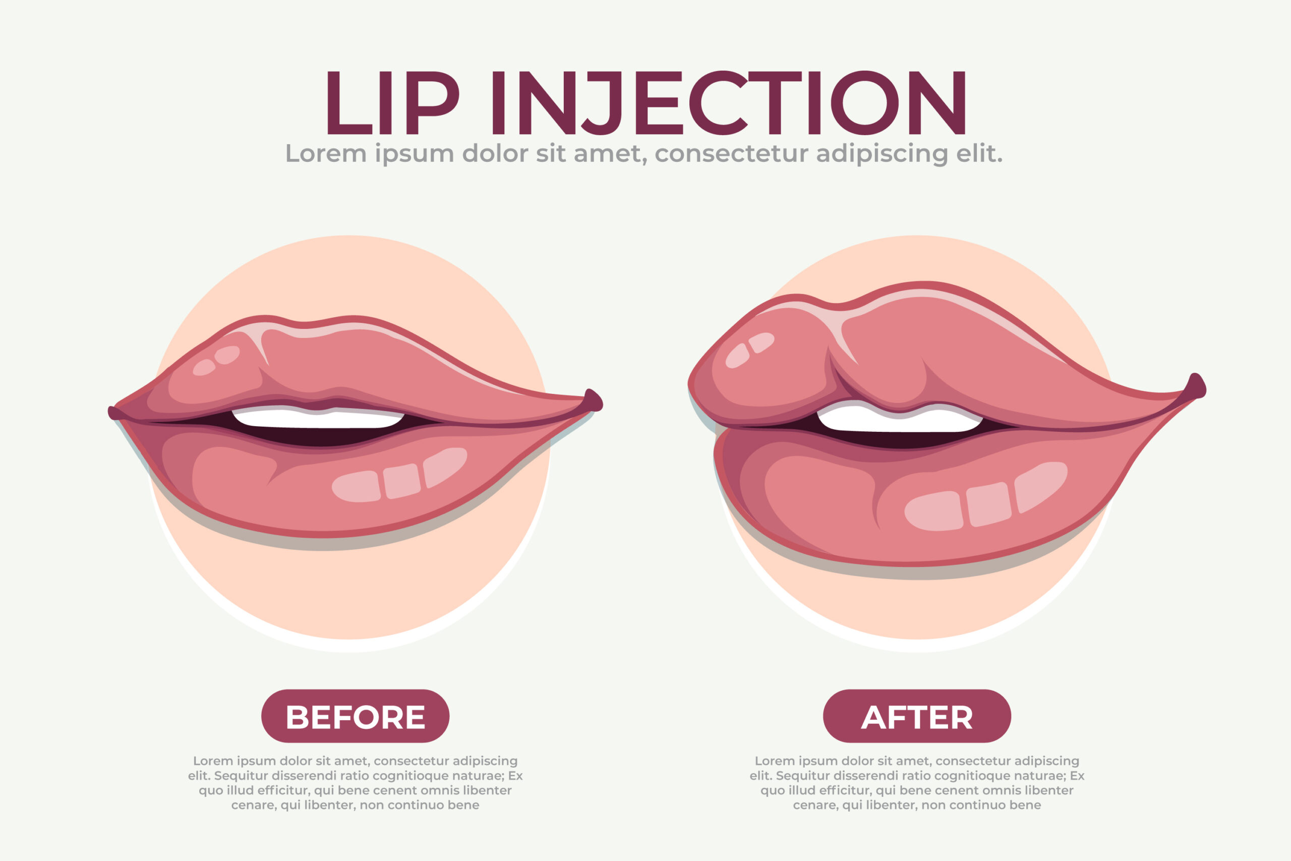 Lip Botox Before and After: Stunning Results, Lip Flip Secrets & Expert ...
